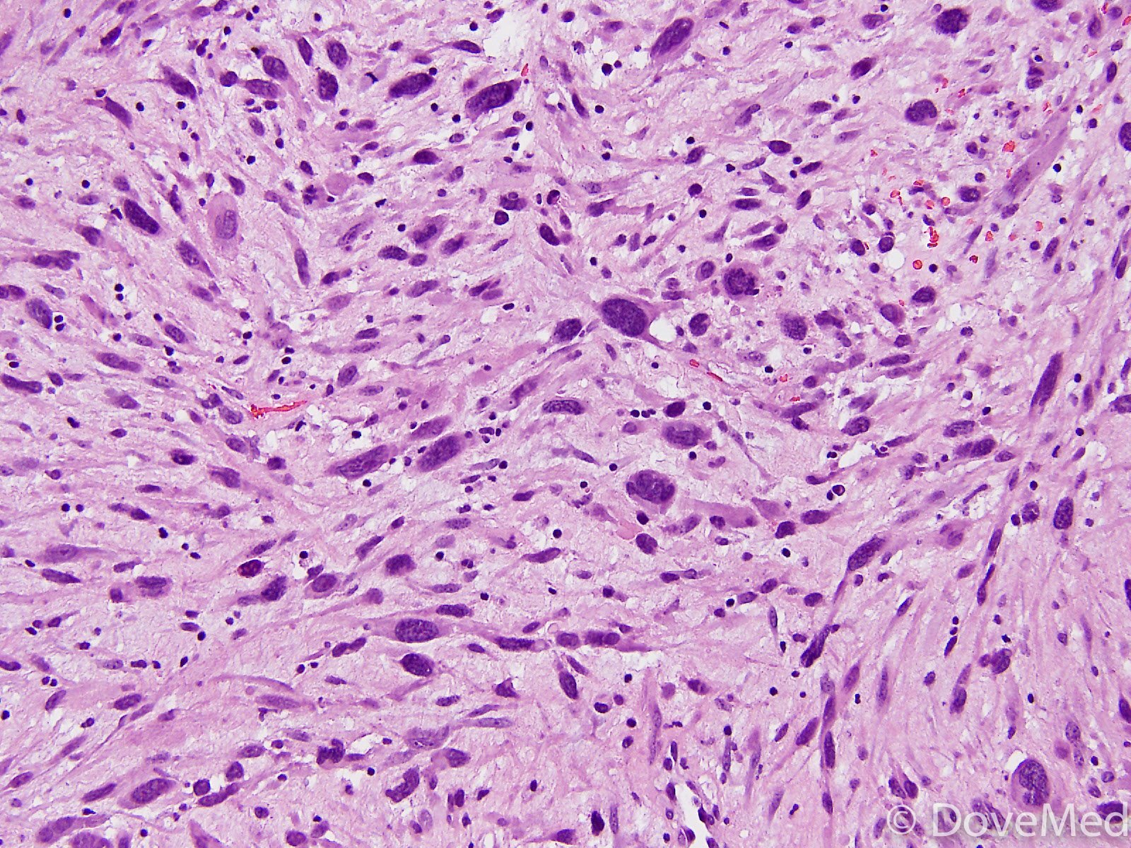 Sarcomatoid Carcinoma of the Lung