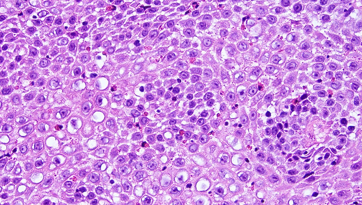 Eosinophilic Esophagitis (EoE)