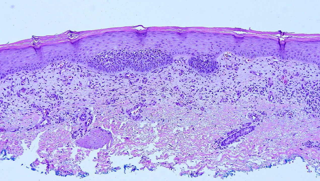 Superficial Basal Cell Carcinoma of Skin