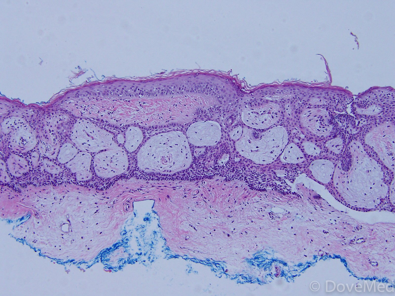 Fibroepithelial Basal Cell Carcinoma of Skin