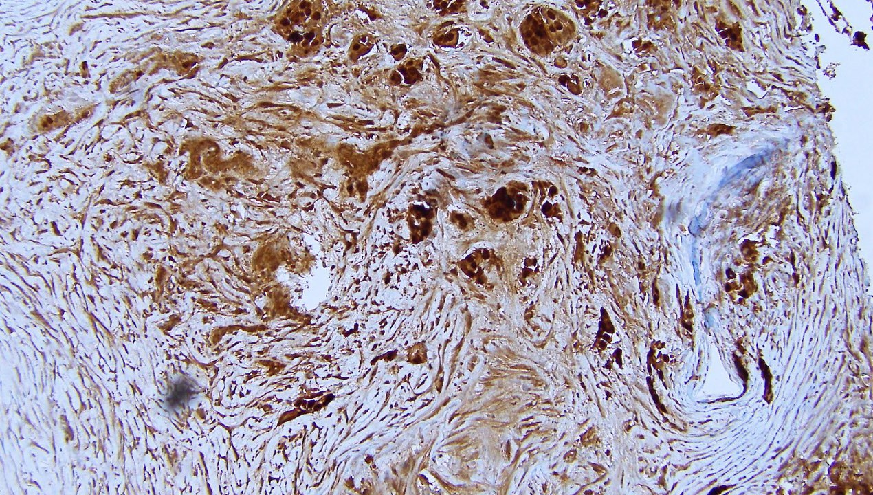 Prostate Specific Antigen (PSA) Blood Test