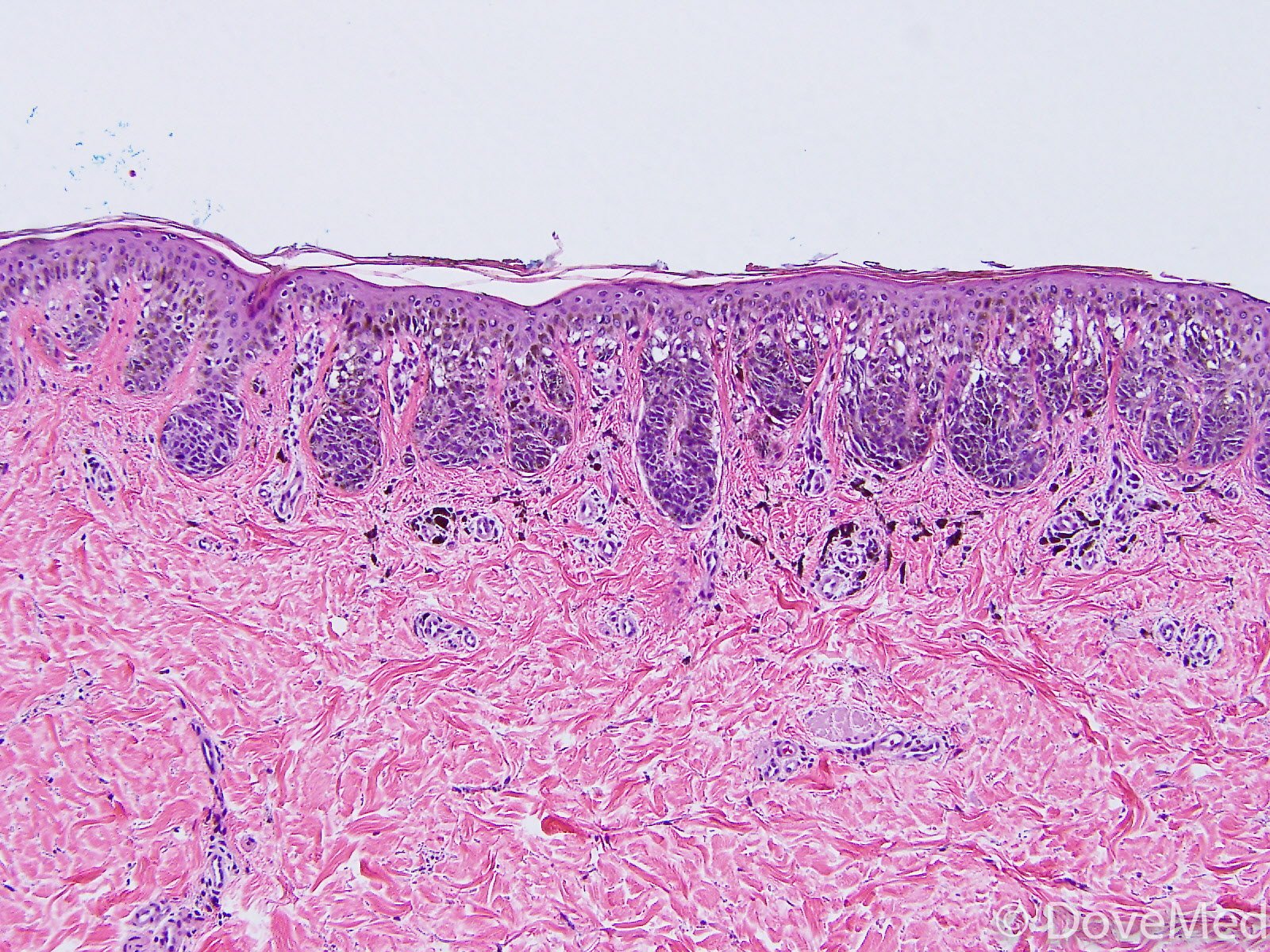 Superficial Spreading Melanoma of Skin