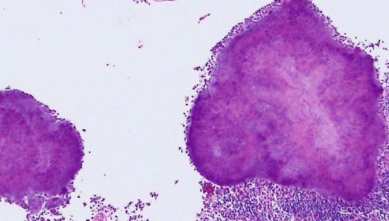 Actinomycosis