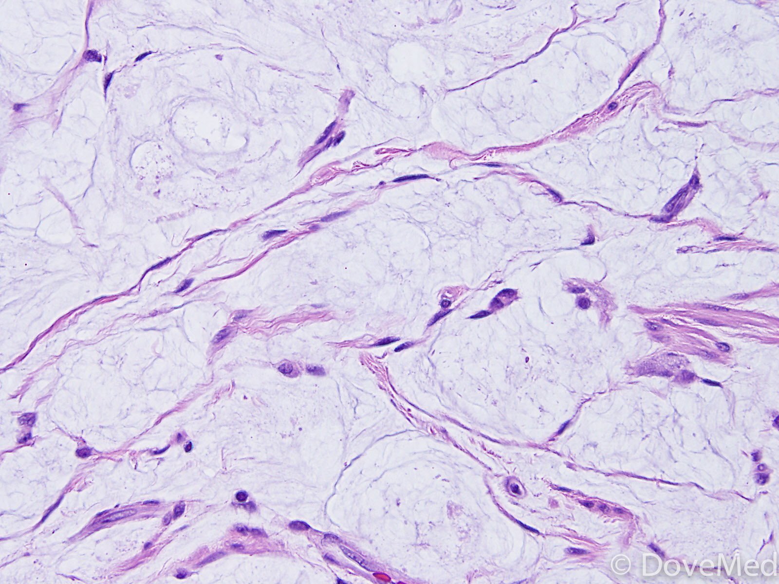 Nerve Sheath Myxoma