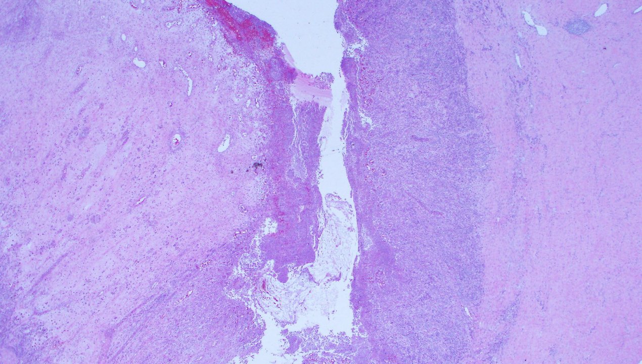 Diverticular Disease