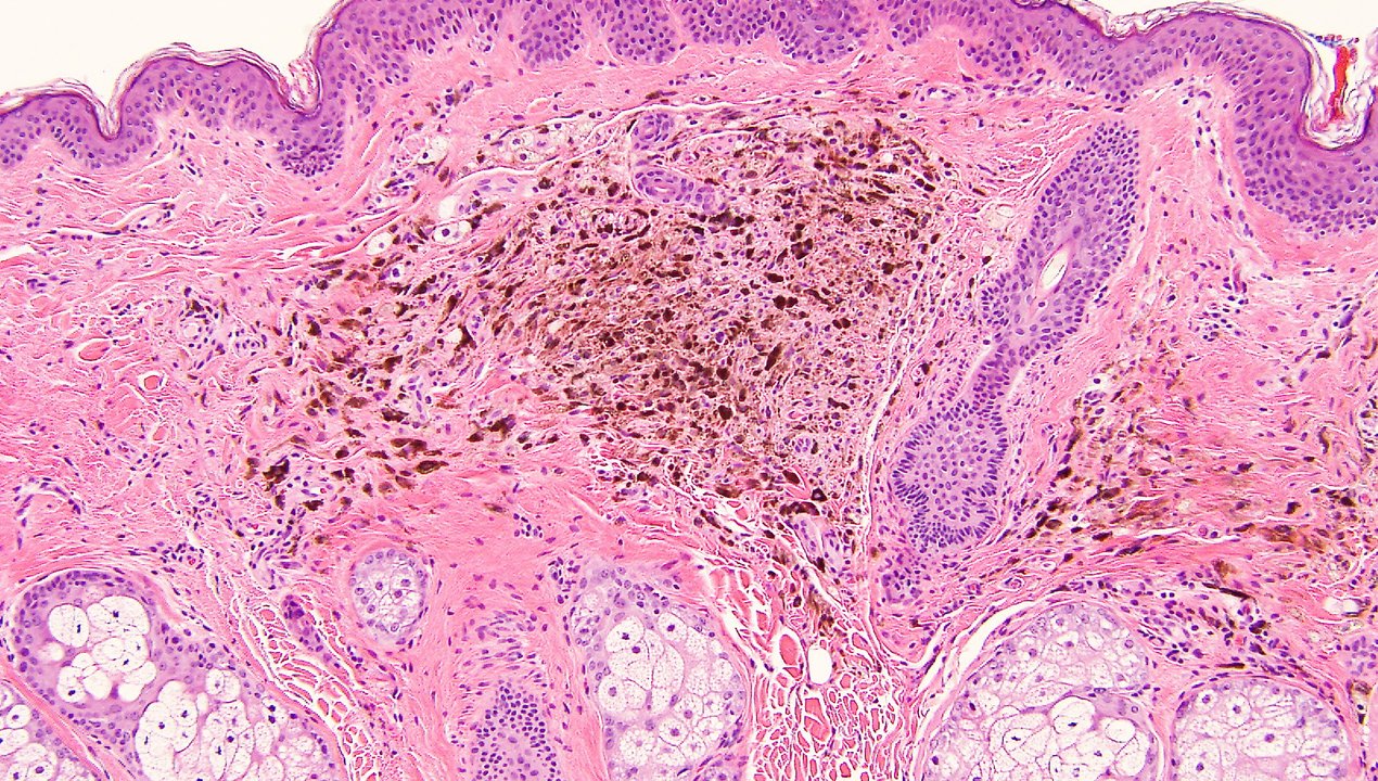 Cellular Blue Nevus