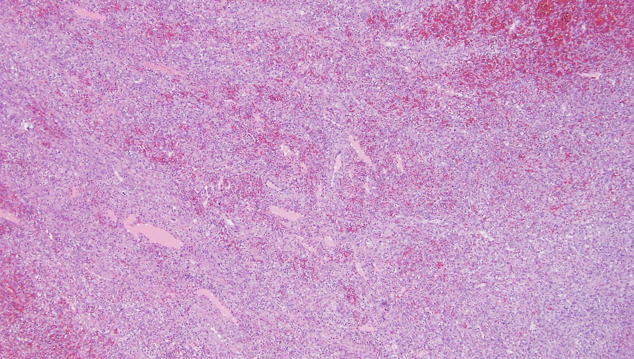 Angiosarcoma of Skin