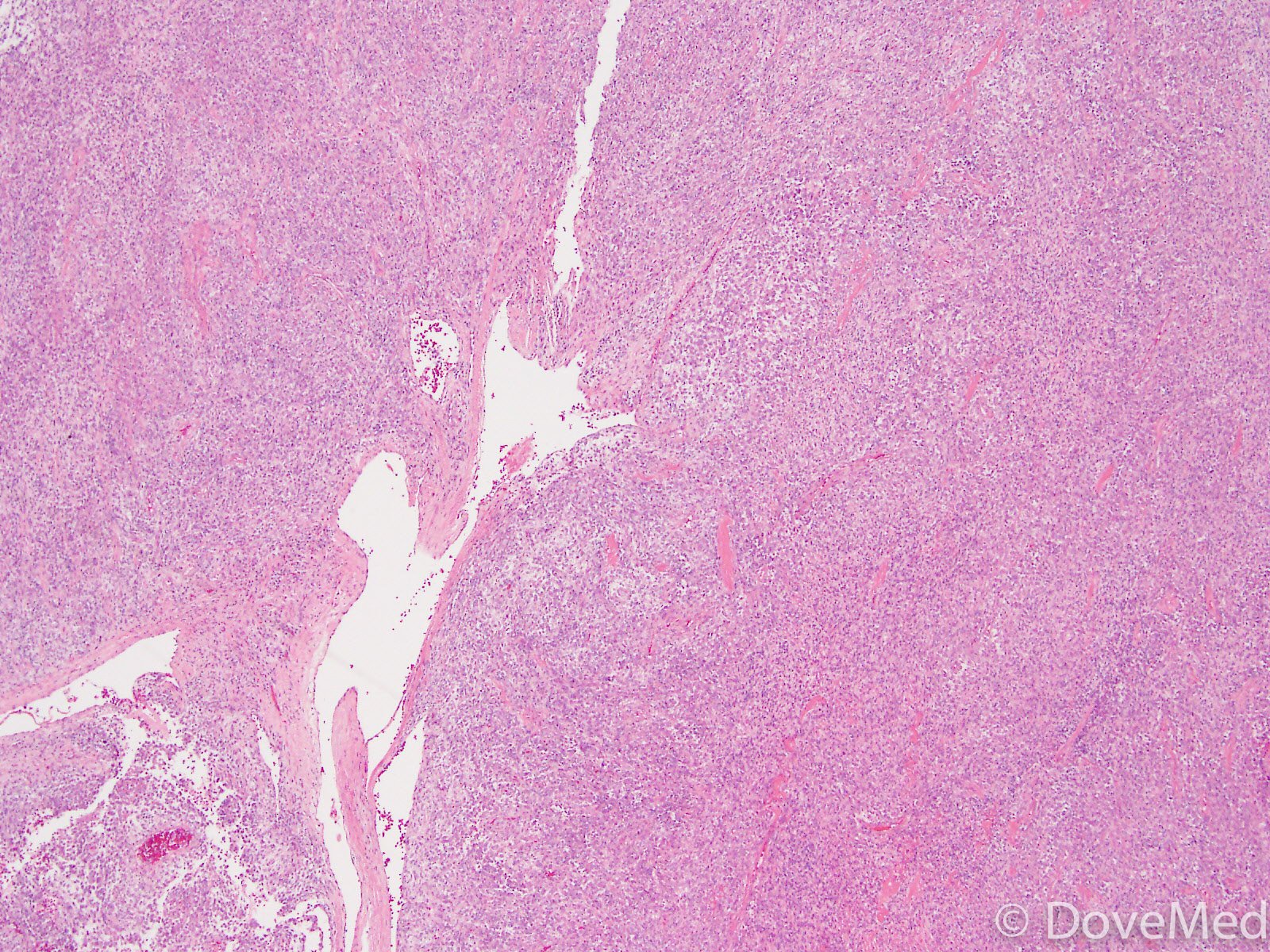 Solitary Fibrous Tumor of Lung