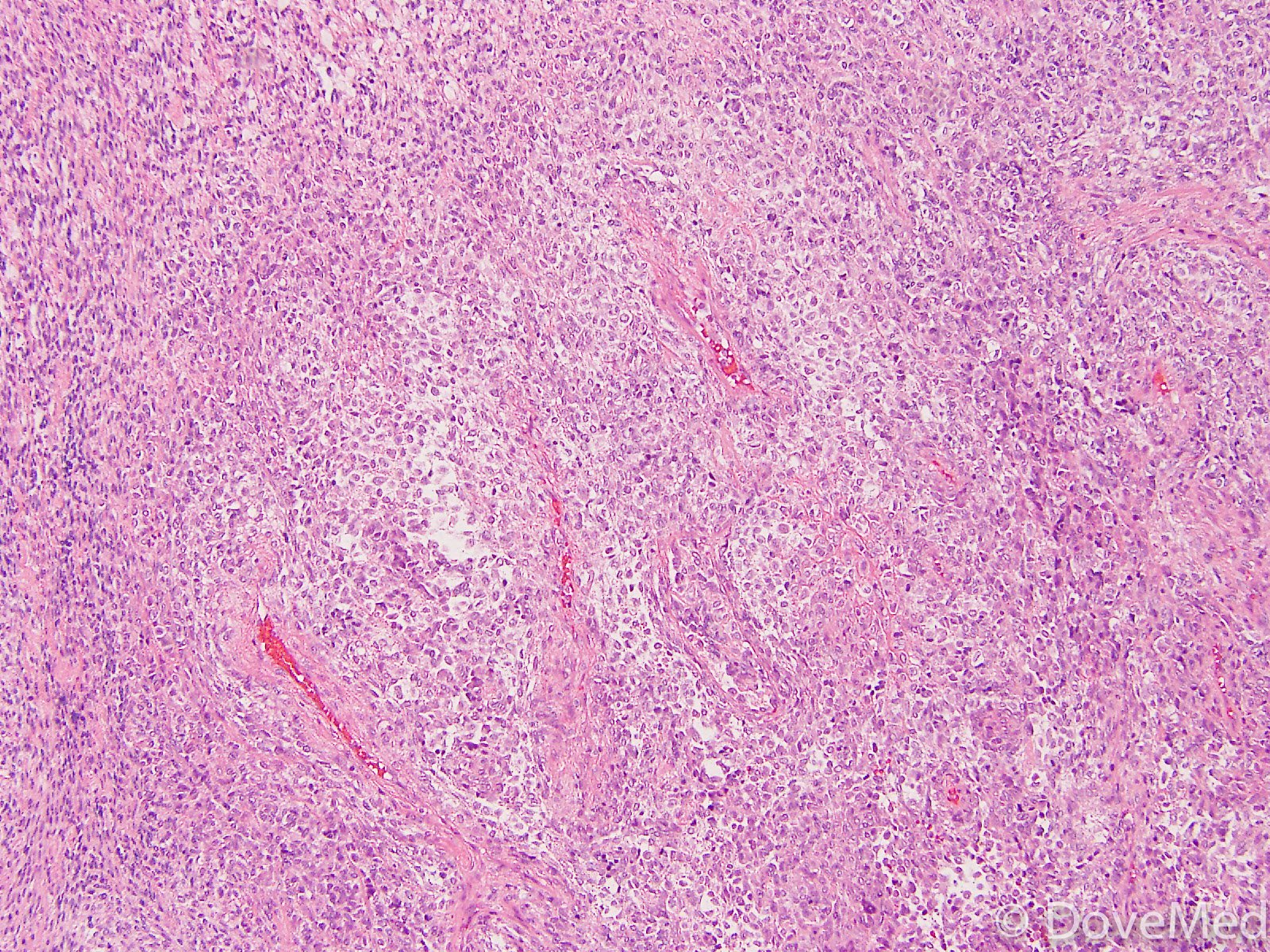 Solitary Fibrous Tumor of Adrenal Gland