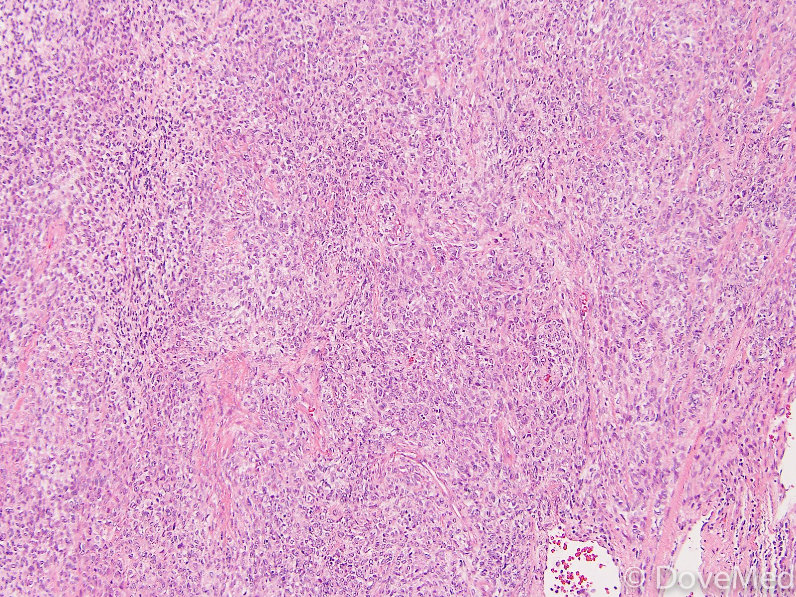 solitary-fibrous-tumor-of-breast