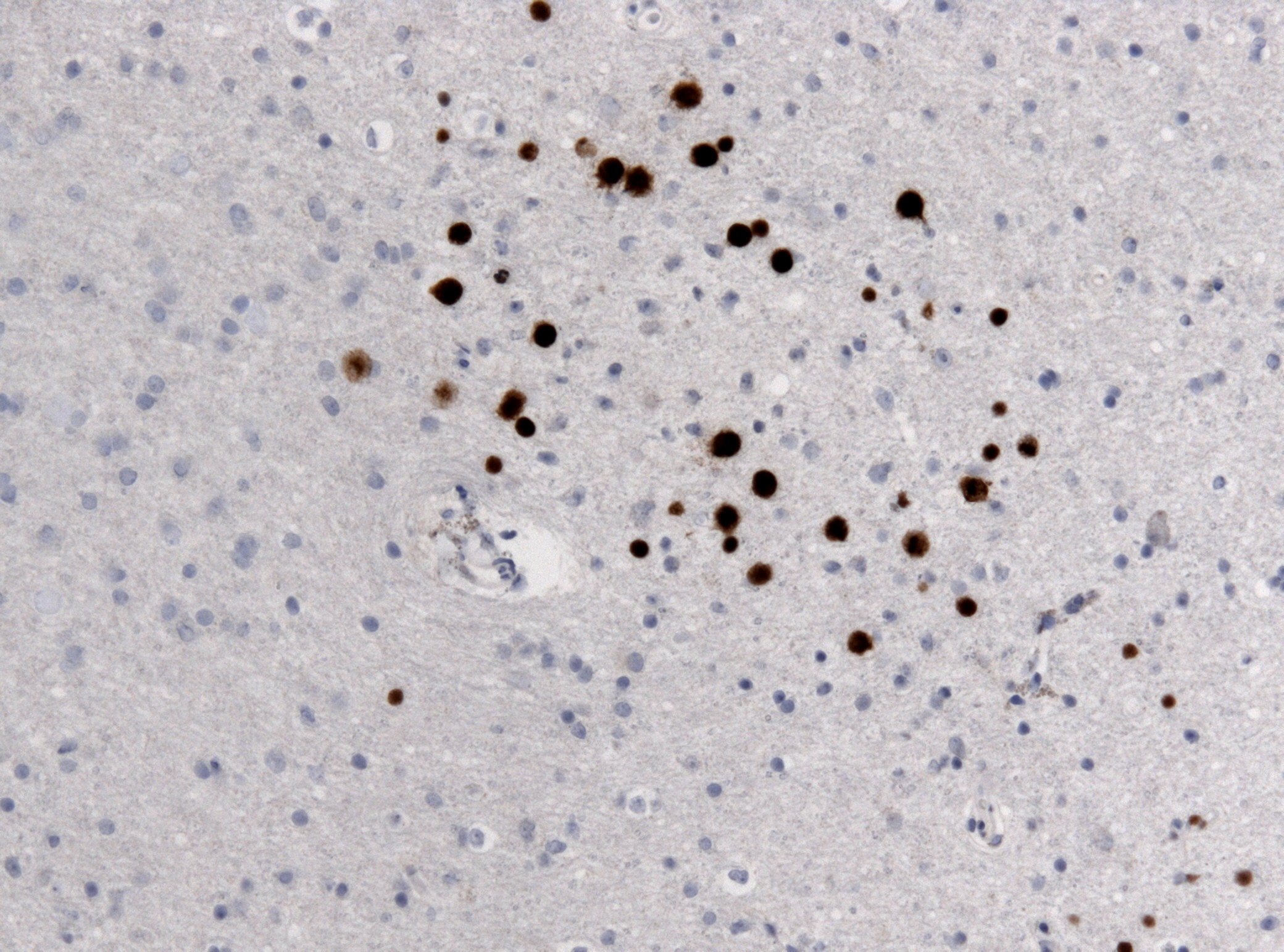 Progressive Multifocal Leukoencephalopathy (PML)