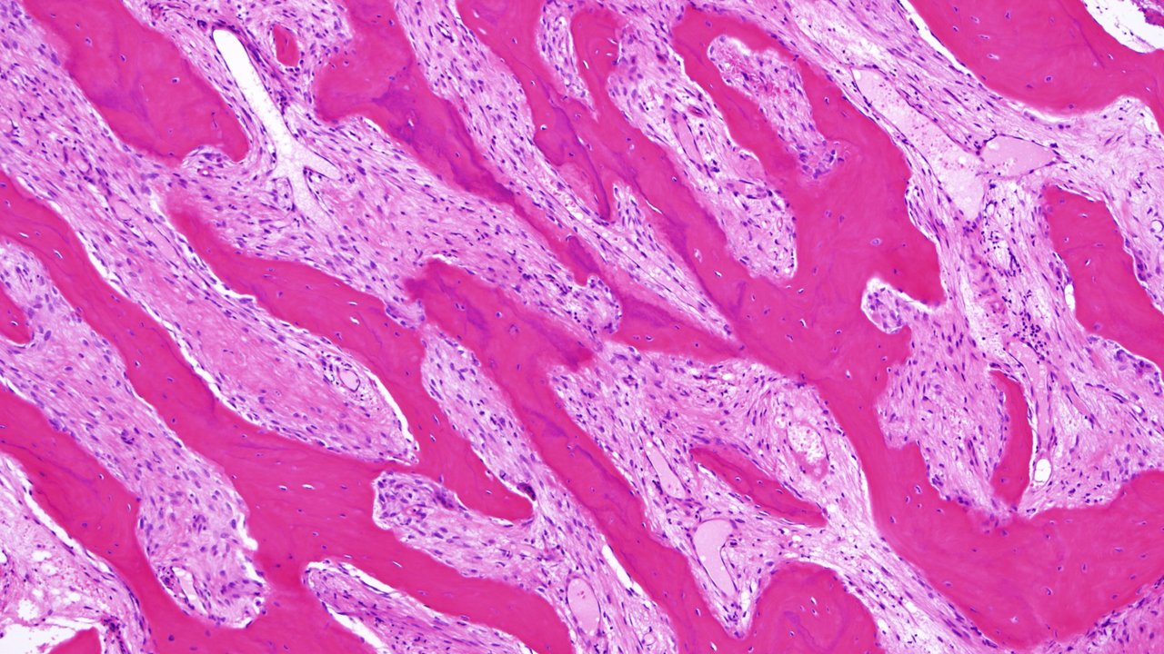 Parosteal Osteosarcoma