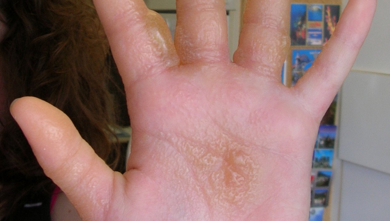 Phytophotodermatitis