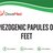Piezogenic Pedal Papules