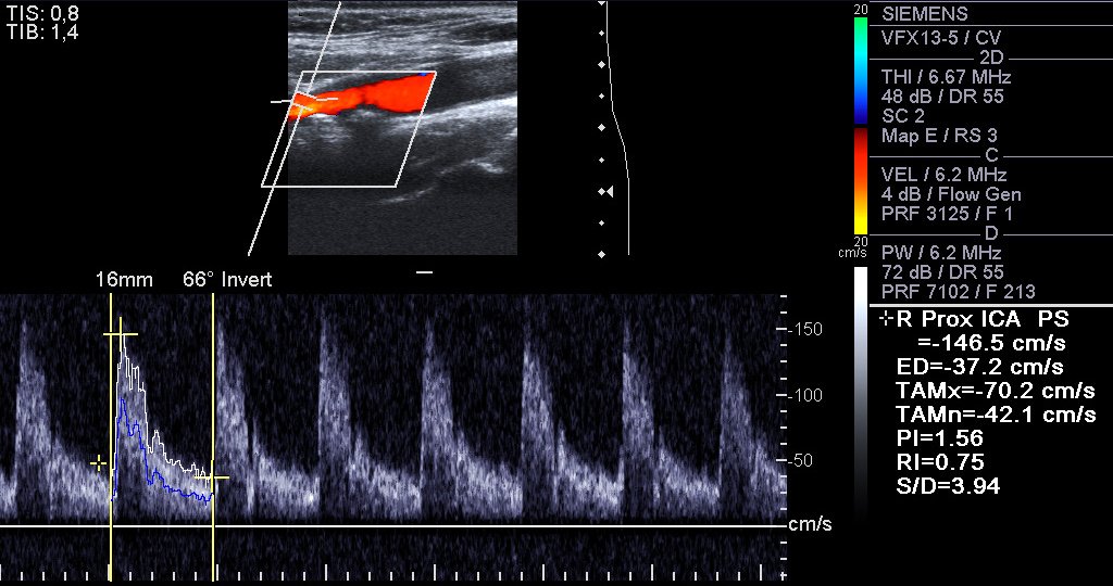 Carotid Artery Ultrasound