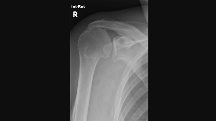 Rotator Cuff Tear (RCT)