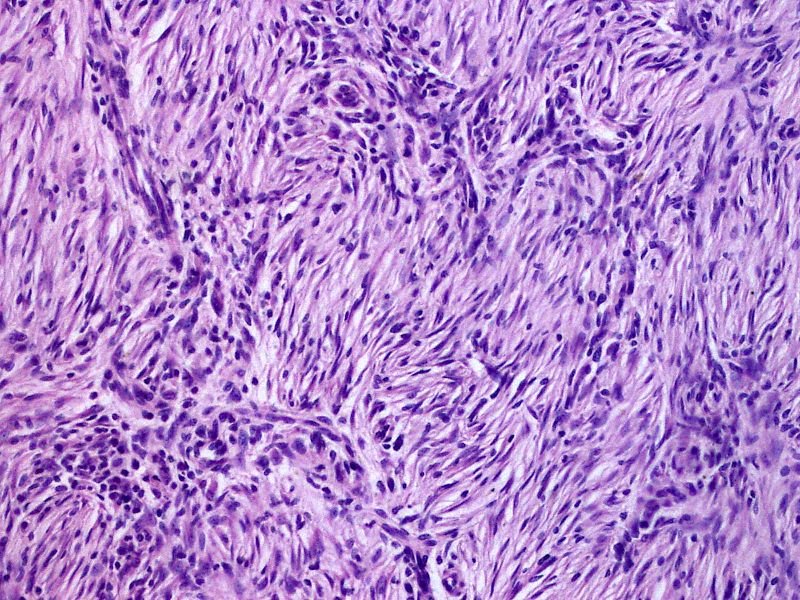 Dermatofibrosarcoma Protuberans (DFSP)