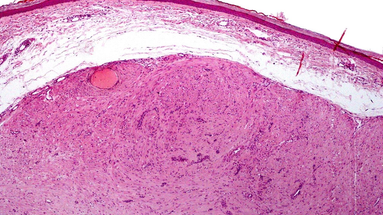 How well do you know Angioleiomyoma