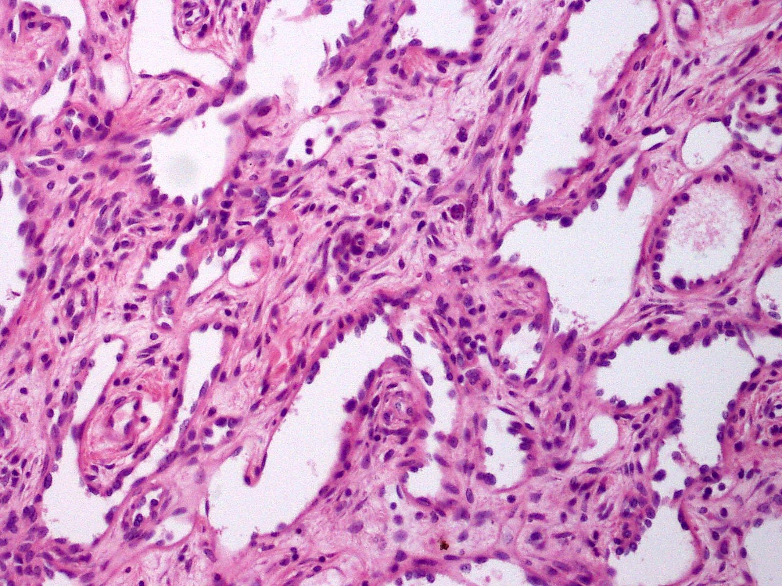 Retiform Hemangioendothelioma