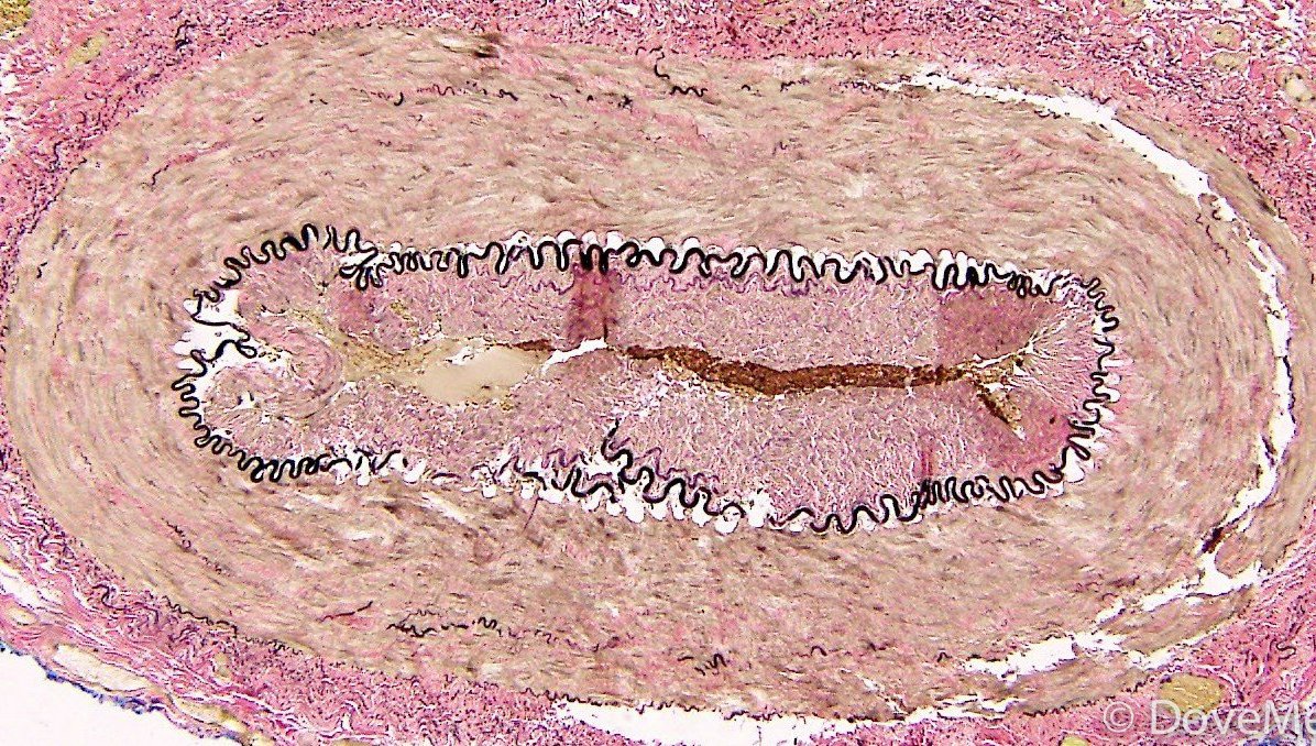 Giant Cell Arteritis (GCA)