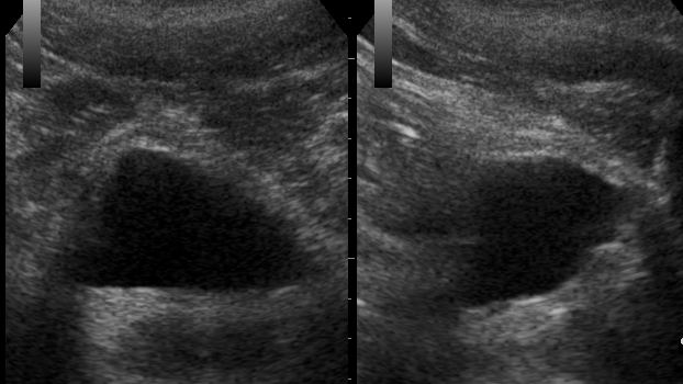 Ultrasound Imaging - Prostate