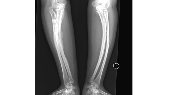 Osteogenesis Imperfecta