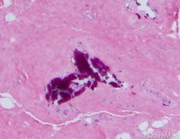 Calcifying Aponeurotic Fibroma