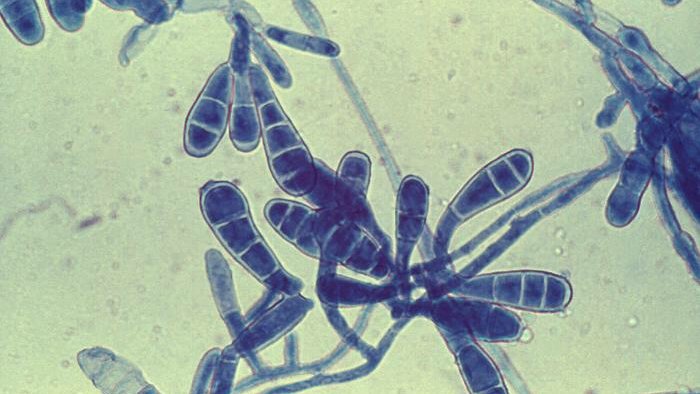 Tinea Corporis Infection