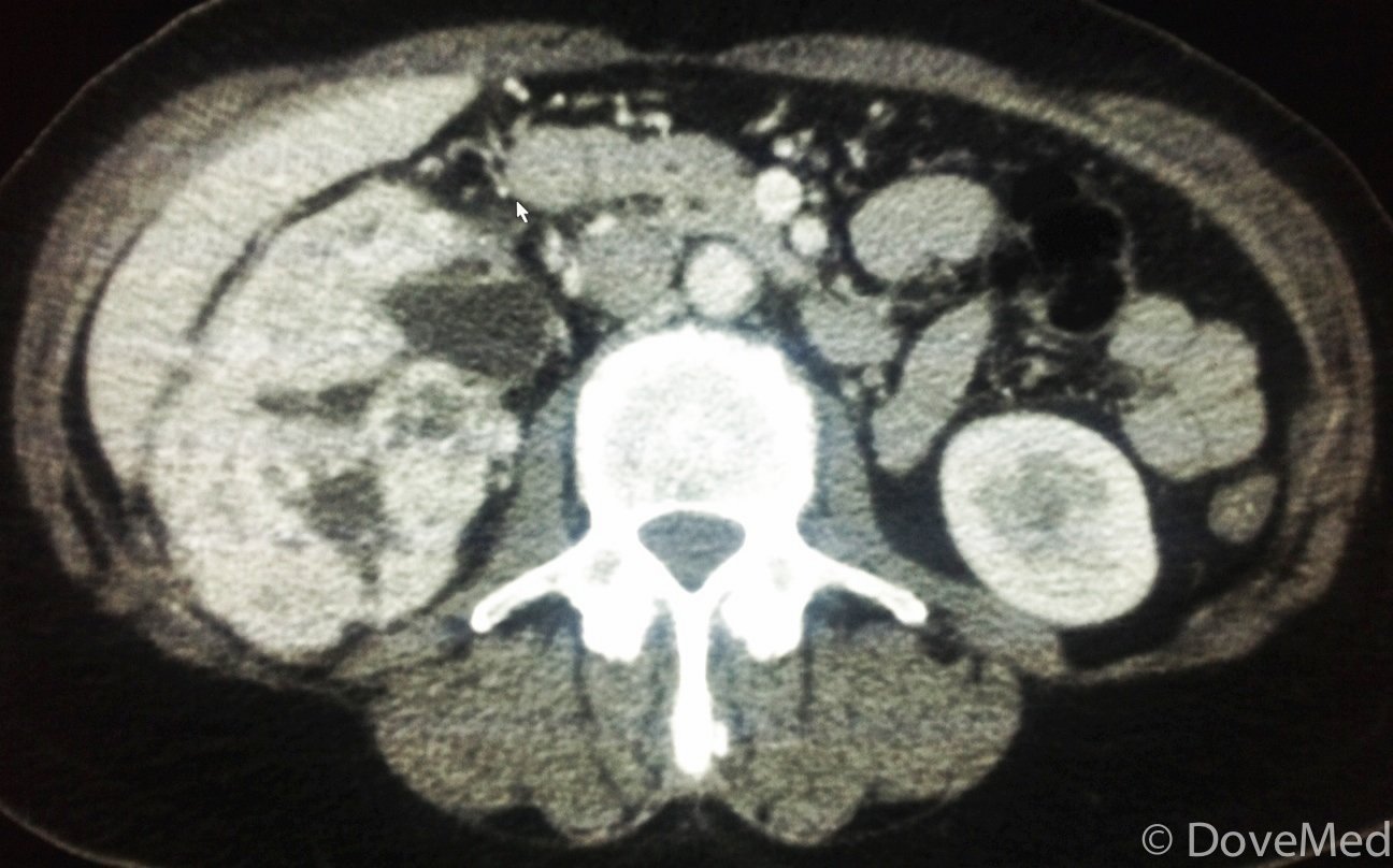Radiofrequency Ablation of Kidney Tumor
