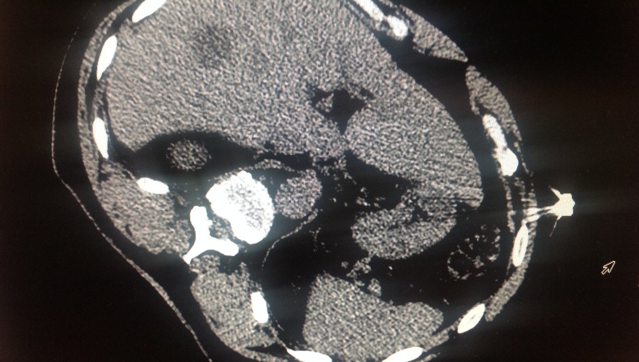 Alpha Feto-Protein (AFP) Tumor Marker Test