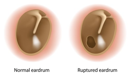 Ruptured Eardrum