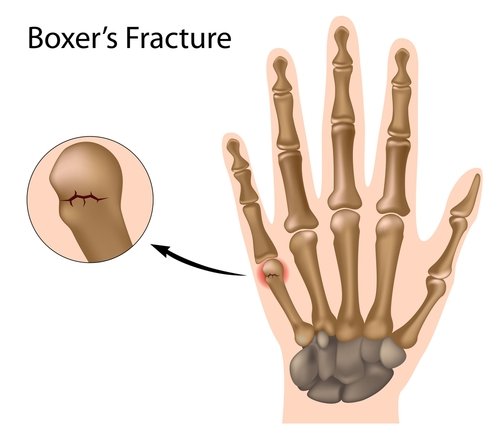 Hand Fracture