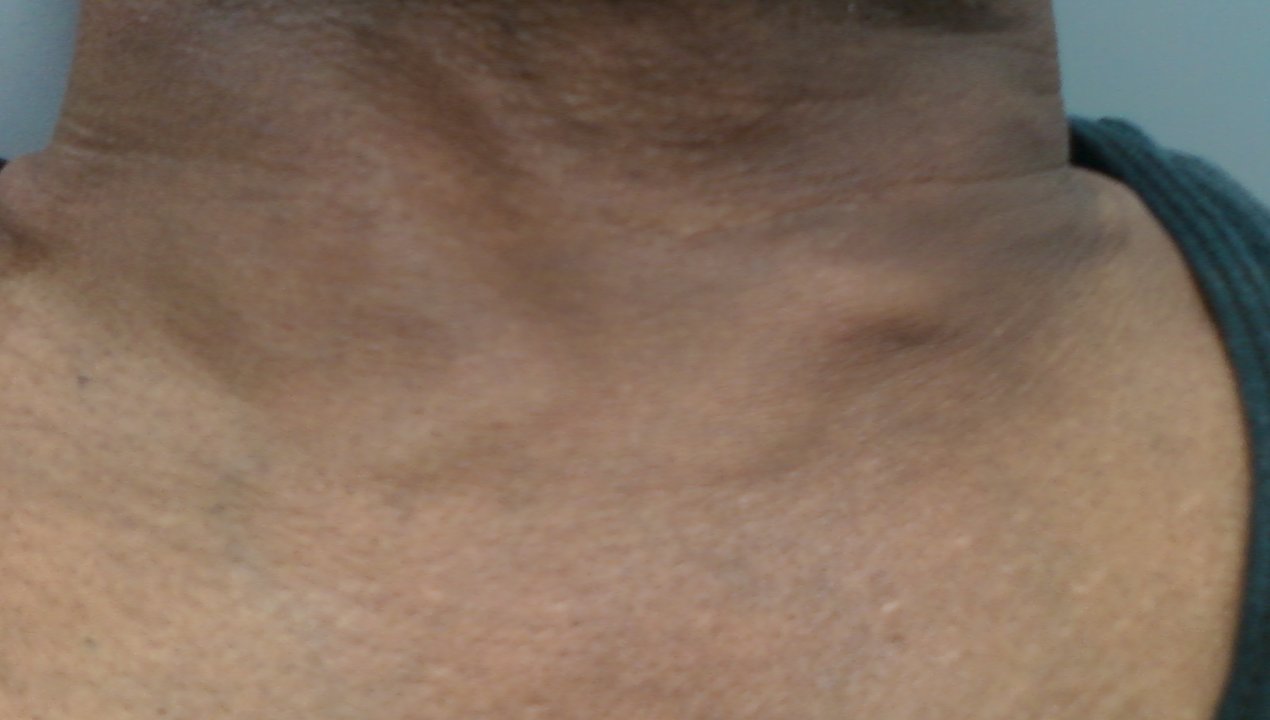 Subcutaneous Emphysema