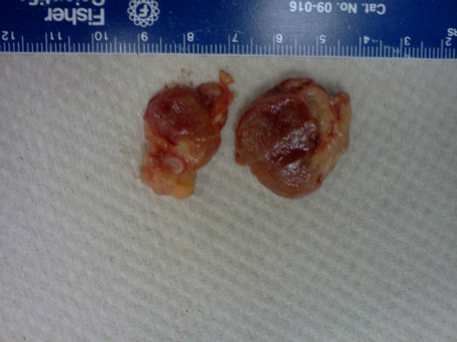 Lumpectomy of Breast