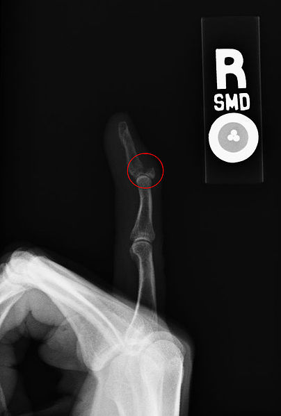 Skin Avulsion Treatment