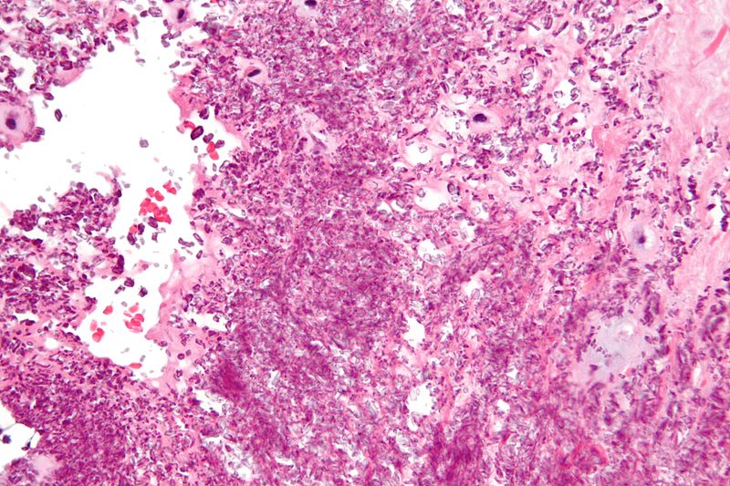 Pseudogout