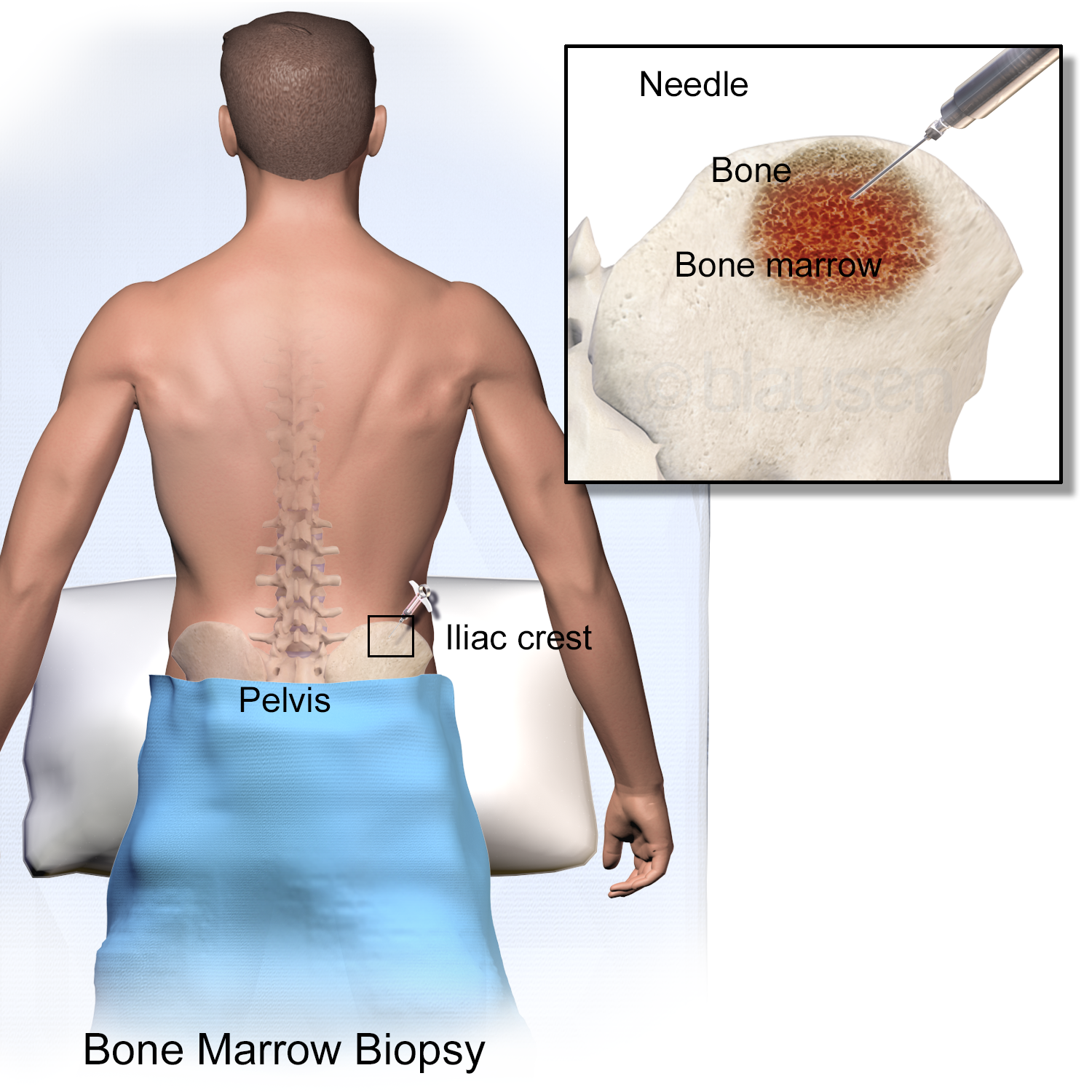 Bone Marrow Aspiration Biopsy Bone Marrow Aspiration Biopsy