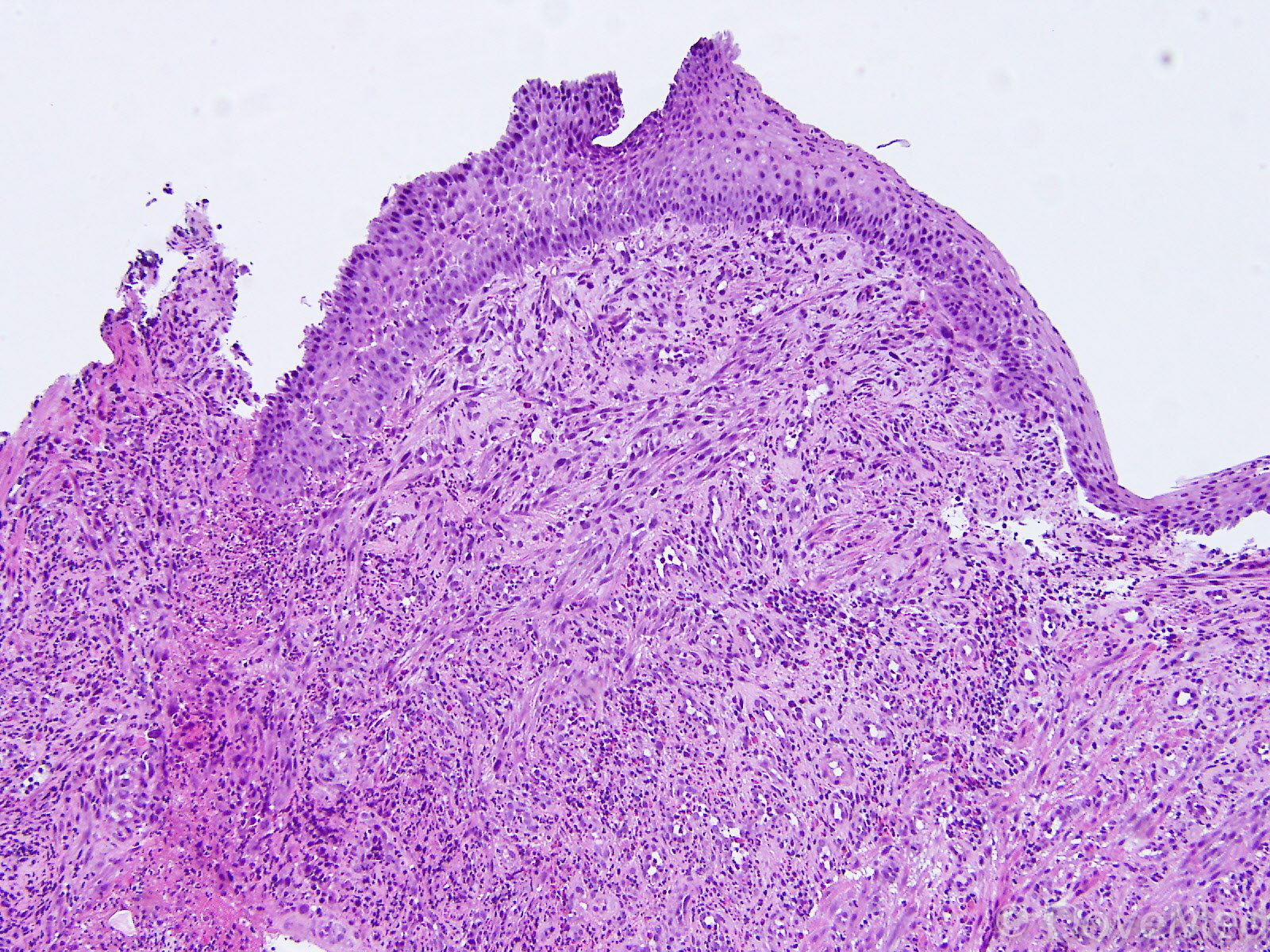Pyogenic Granuloma