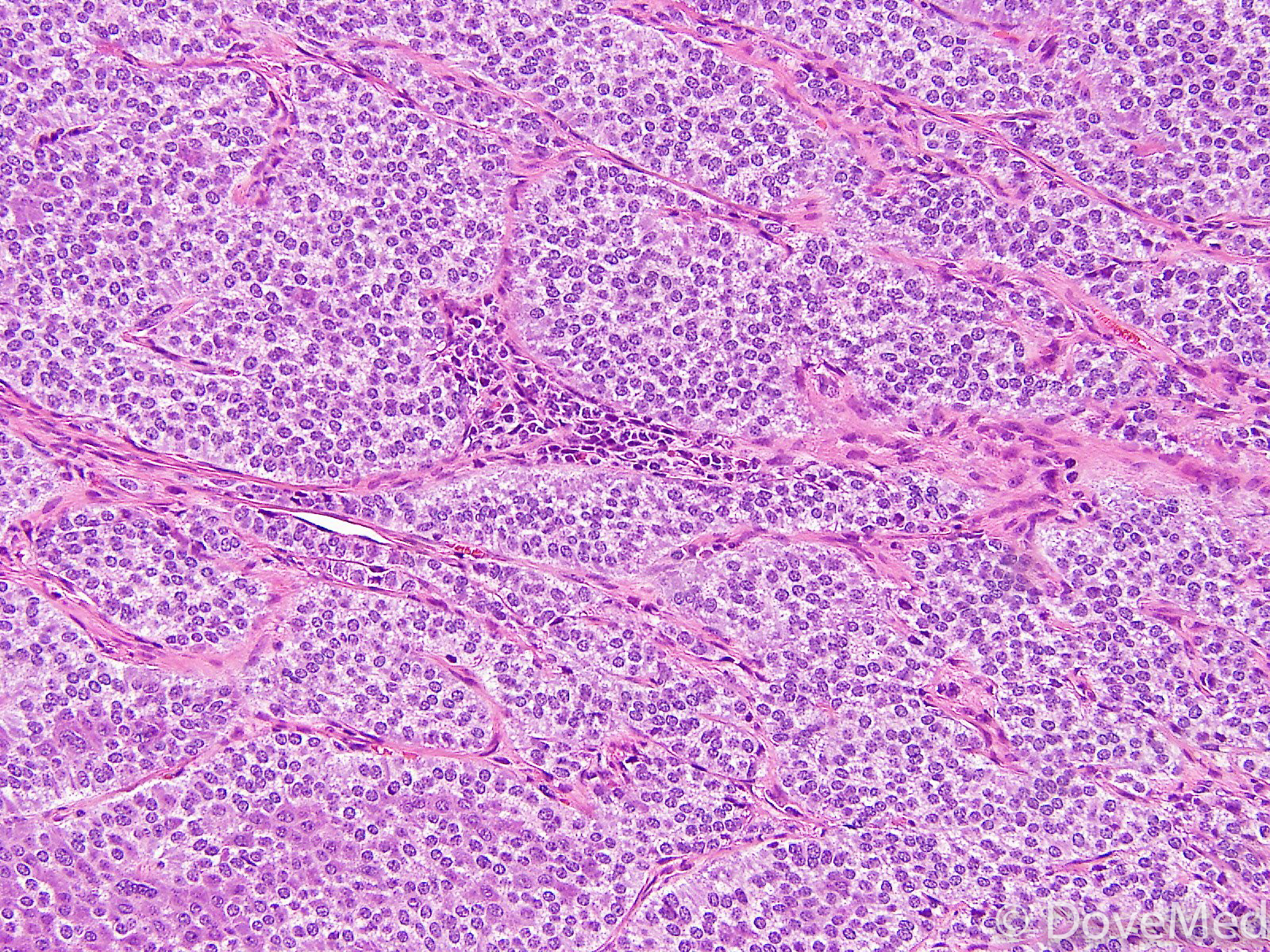 Malignant Glomus Tumor