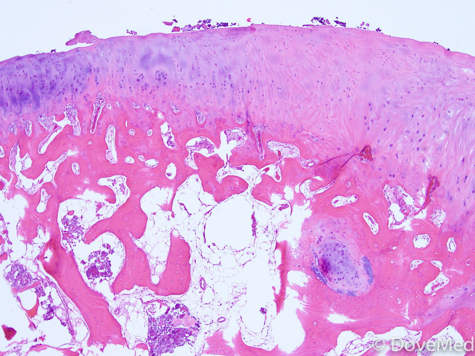 Bone Tumor - Osteochondroma