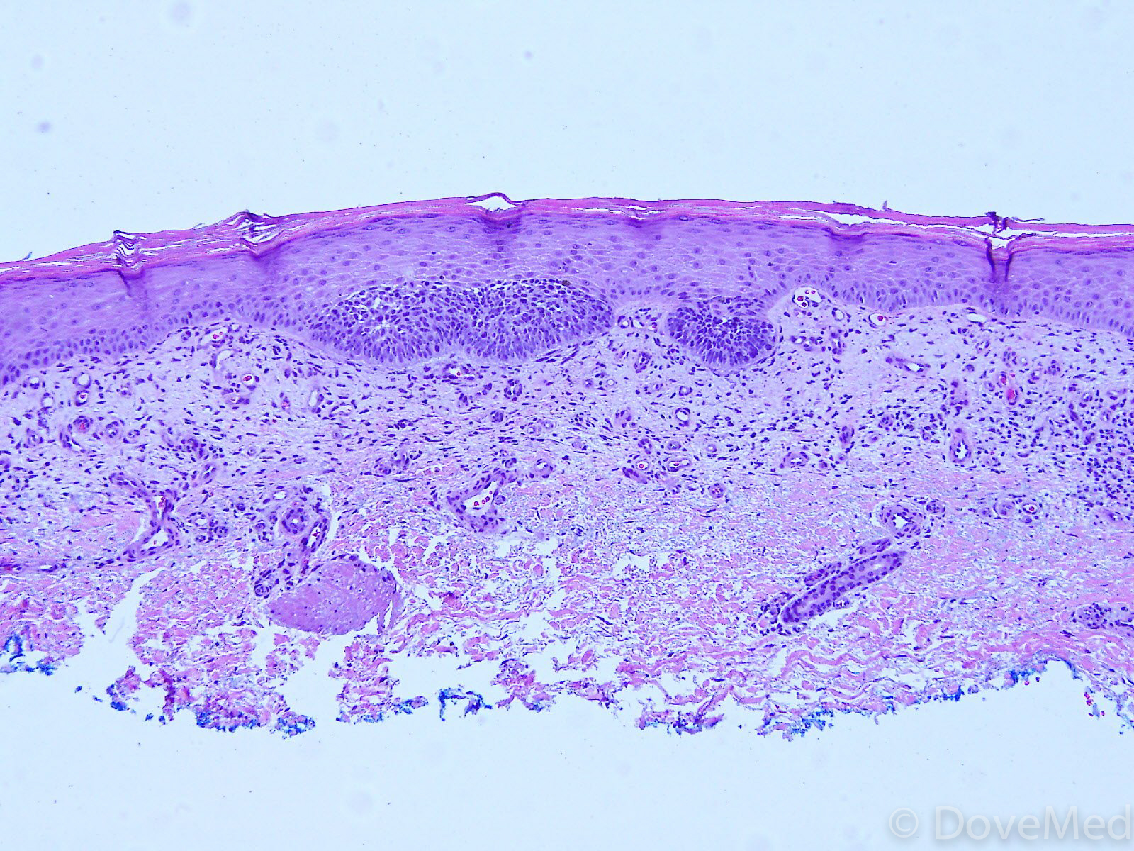 Superficial Basal Cell Carcinoma of Skin