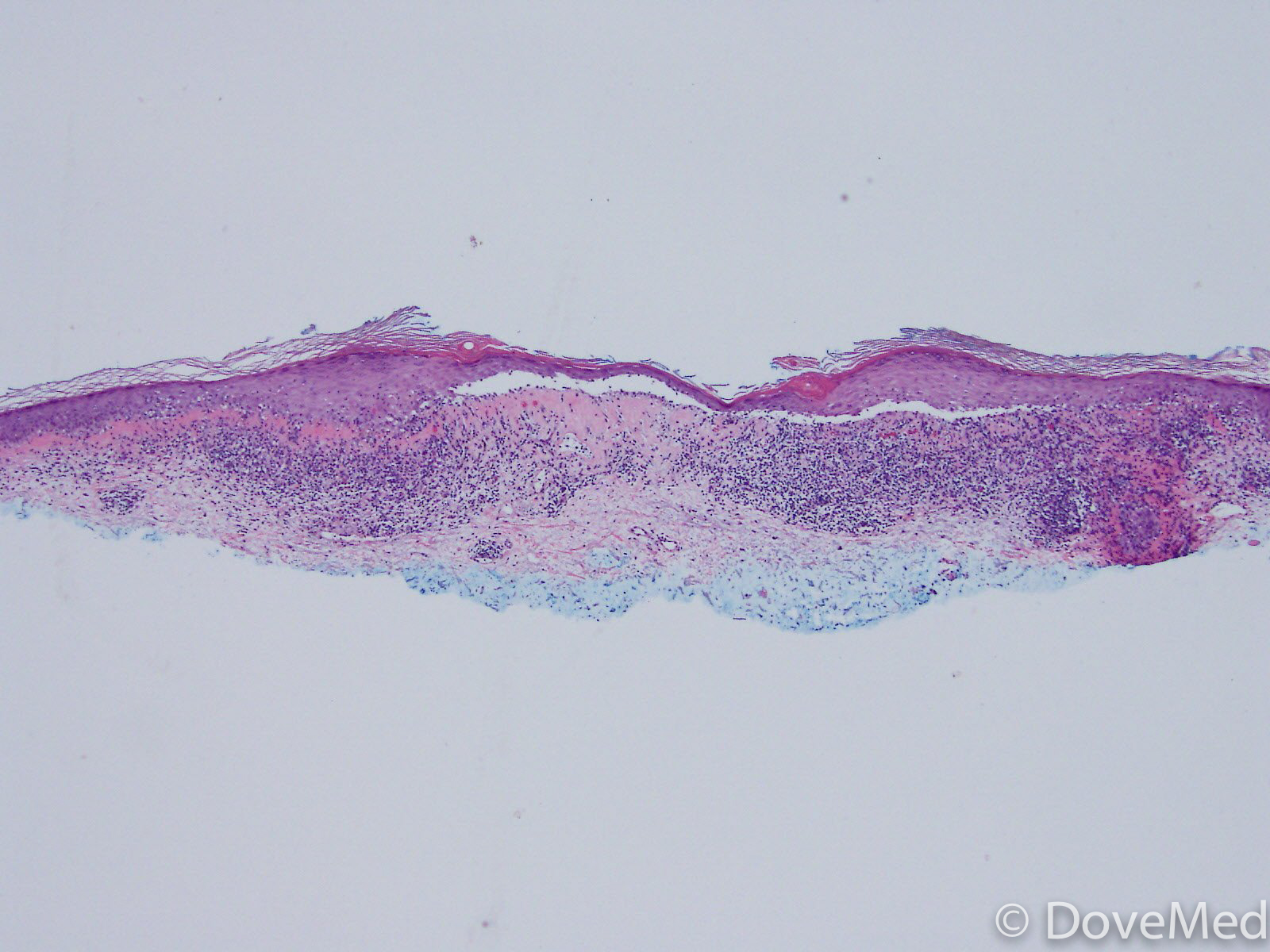 Lichen Planus