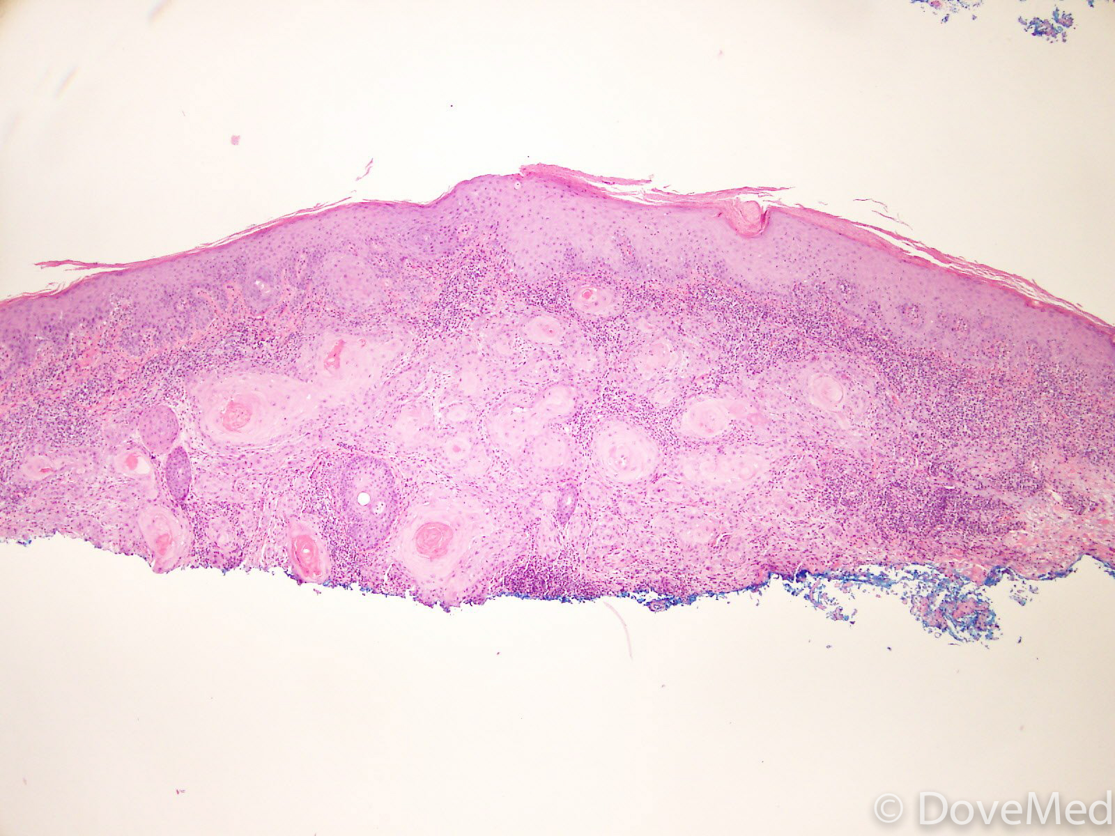 Metastatic Squamous Cell Carcinoma of Skin