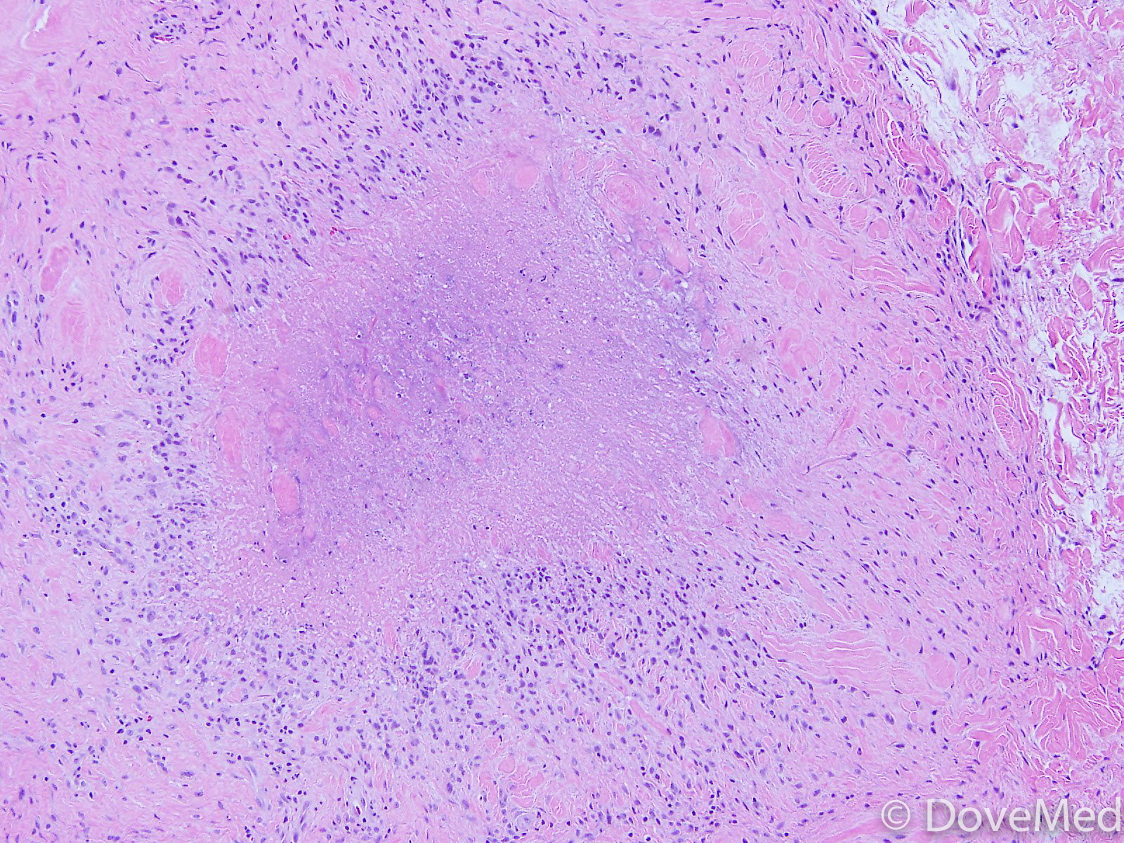 Tuberculin Skin Test for Tuberculosis