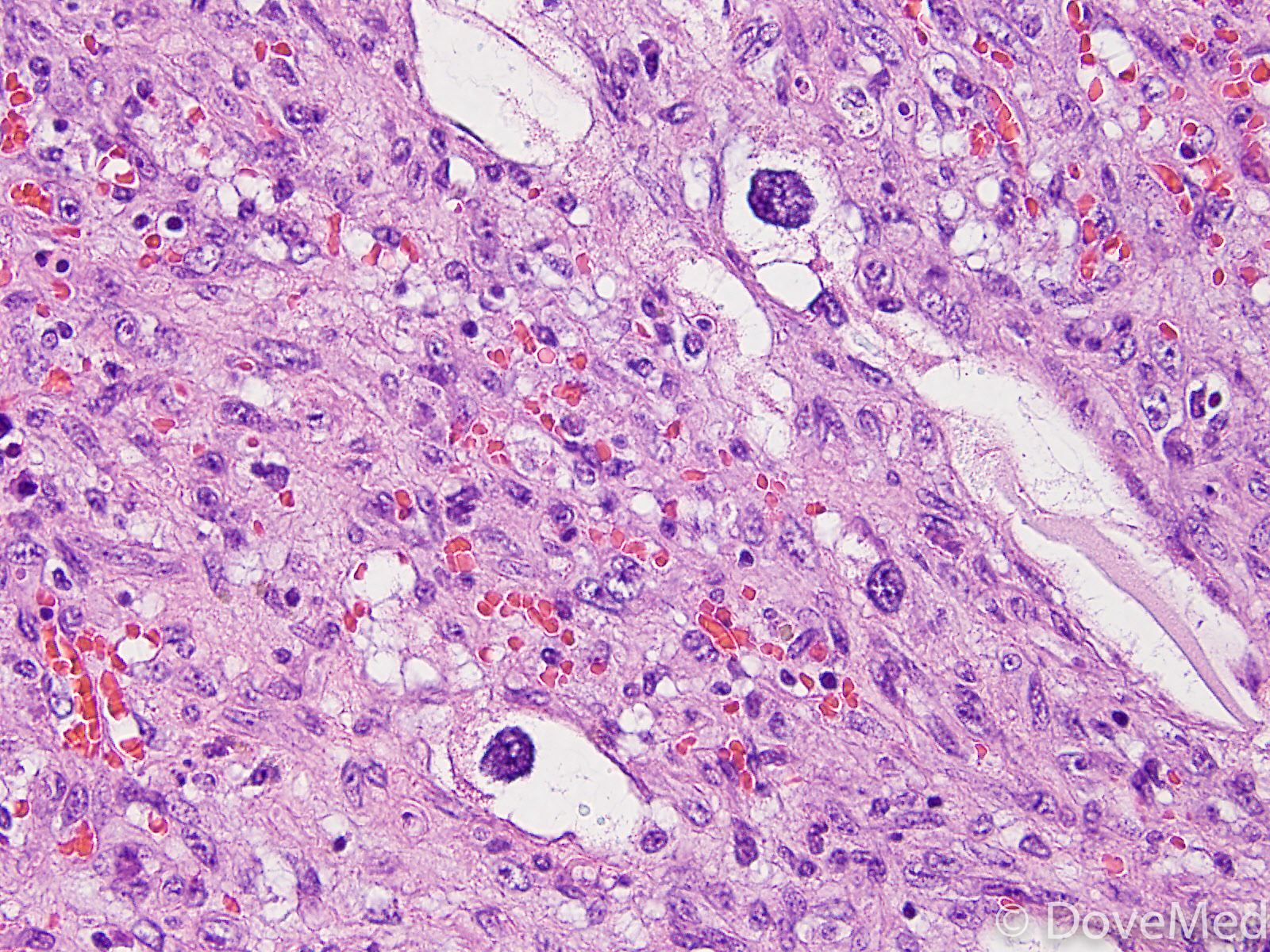 Angiosarcoma of Bone