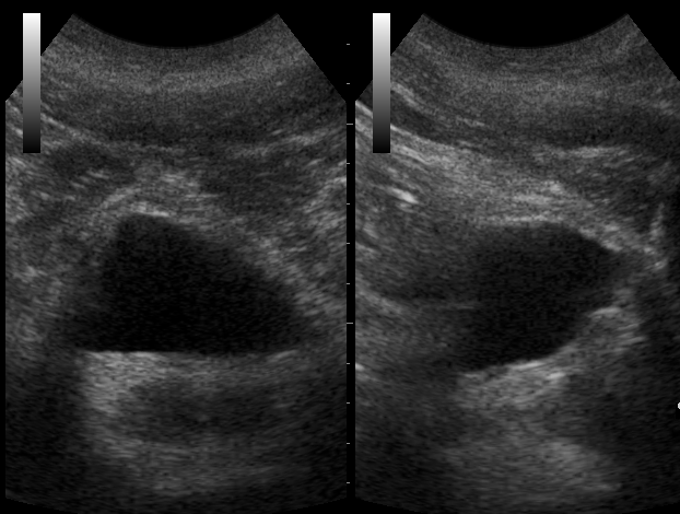 Ultrasound Imaging - Prostate
