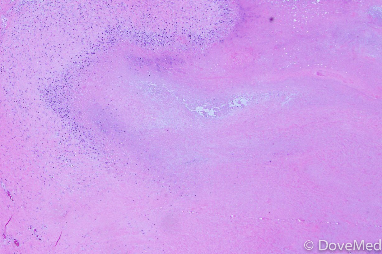 Granulomatosis with Polyangiitis (Wegener Granulomatosis)