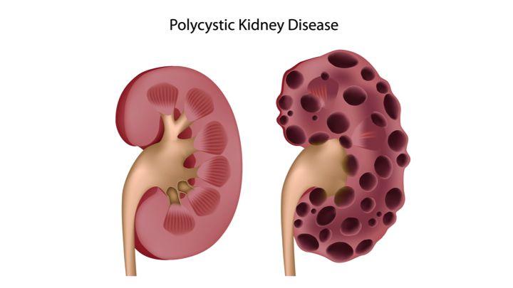 Polycystic Kidney Disease